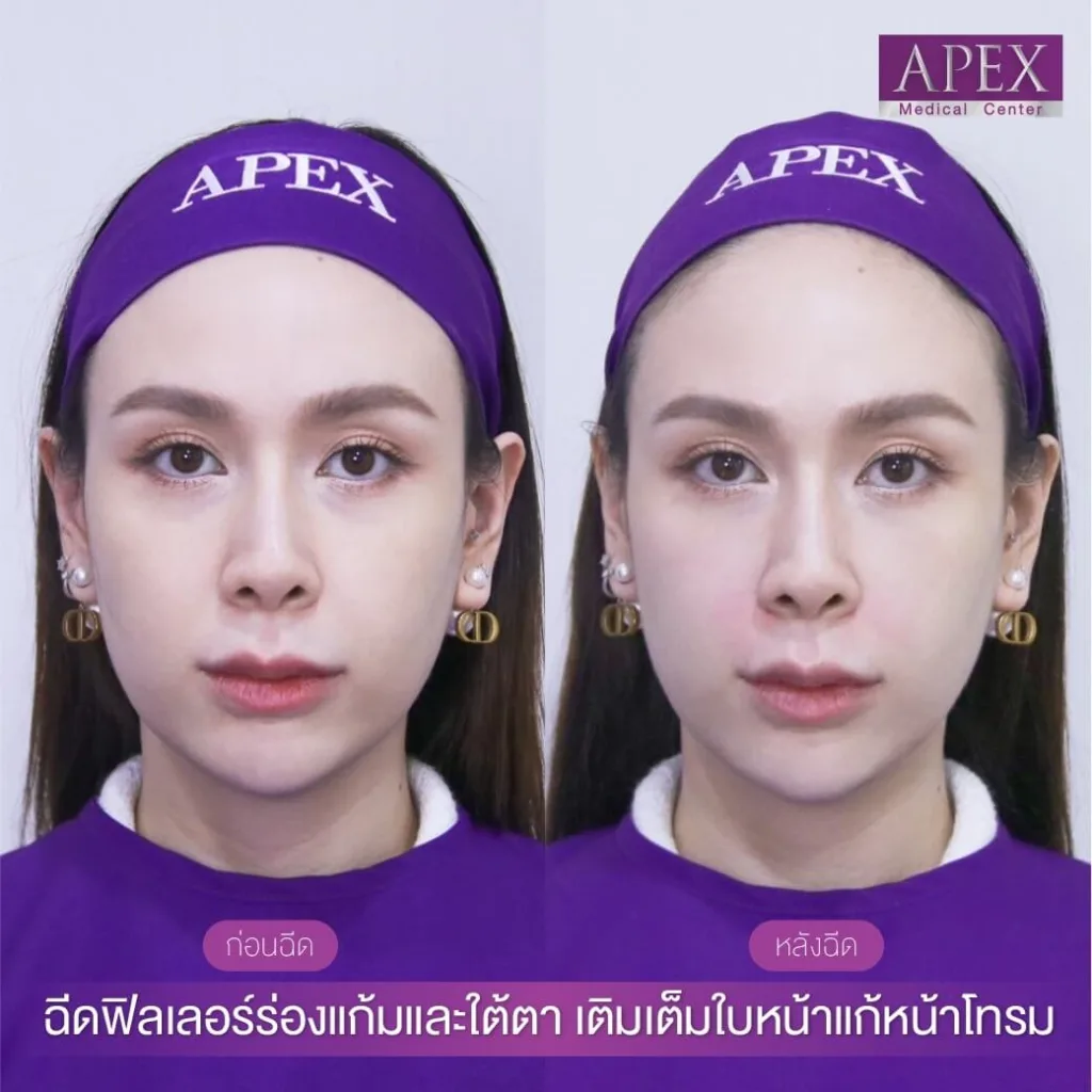 ฟิลเลอร์ร่องแก้ม อันตรายไหม ฟิลเลอร์ร่องแก้ม ที่ไหนดี การดูแลก่อน-หลังฉีด