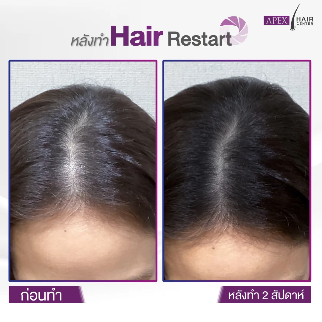 คุณกิ๊ก สุวัจนี นางร้ายตัวแม่เผยเคล็ดลับผมหนาด้วยโปรแกรม Hair Restart ...